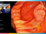 Cecal Colon, 20 Millimeters Flat Polyp, Underwater Hybrid Polypectomy ...