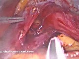 Laparoscopic Heller Myotomy and Dor Fundoplication for Treatment of ...